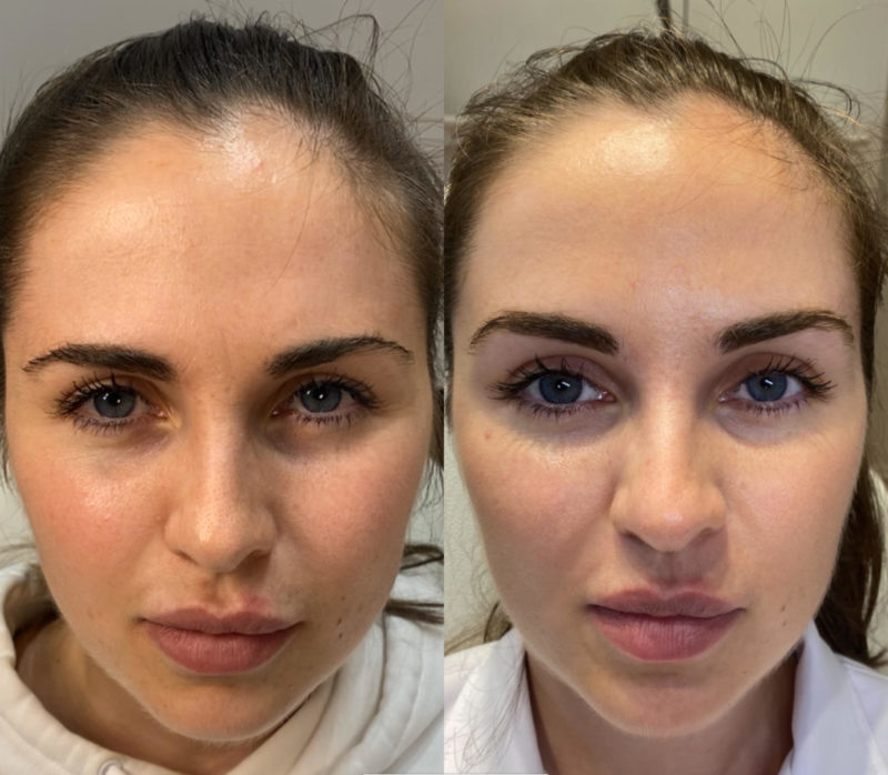 Lifting Sprâncene - Clinica Angi San Buzău